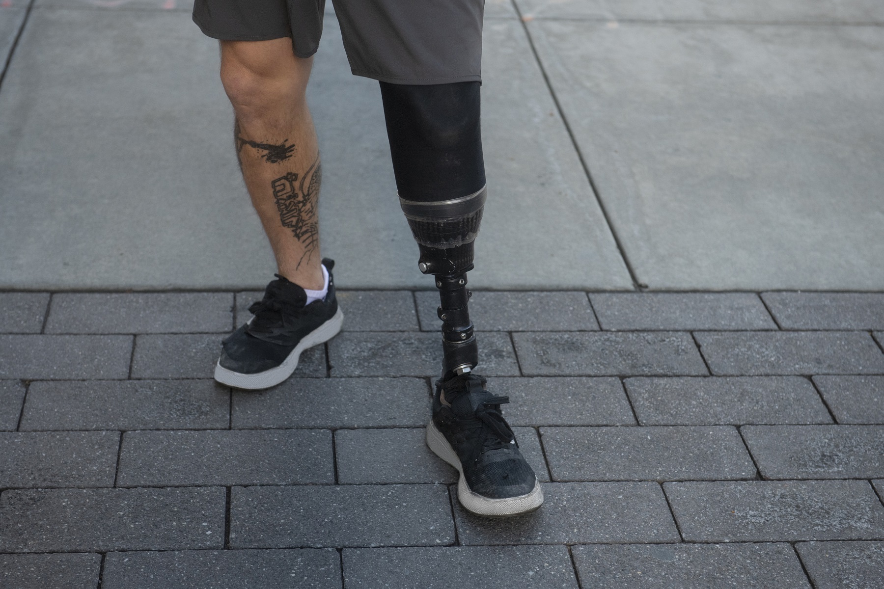£2.3 Million Settlement for an unnecessary amputation - Williamsons ...